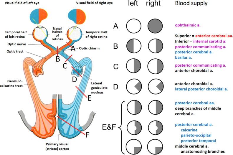 What Is Bitemporal Hemianopia OBN