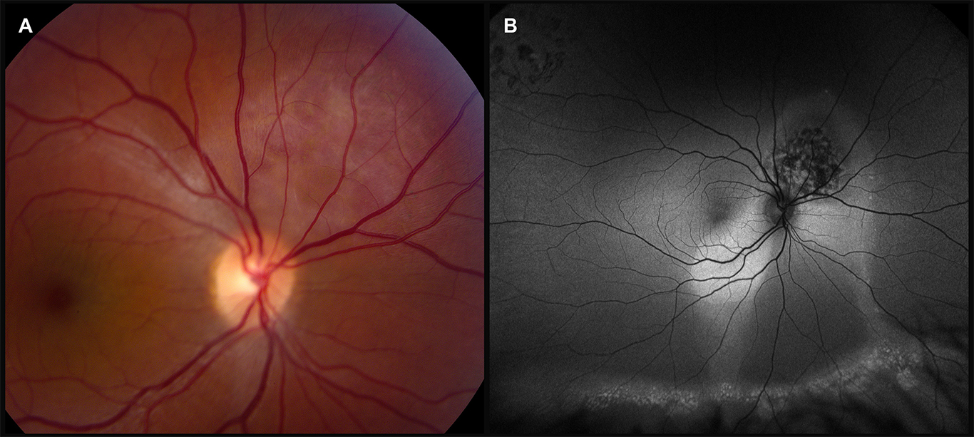 What Is Choroidal Hemangioma? | OBN