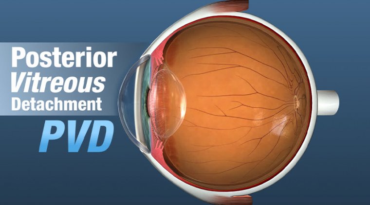 Ophthalmology News | OphtalmicNews | Diagnosing A Posterior Vitreous ...