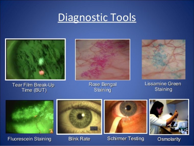 Dry Eye Testing New Diagnostic Tools Ophthalmology Breaking News