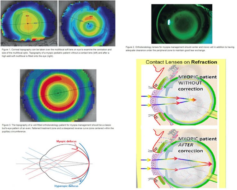 Slowing The Myopia In Children With Contact Lenses OBN Slowing The Myopia In Children With Contact Lenses OBN